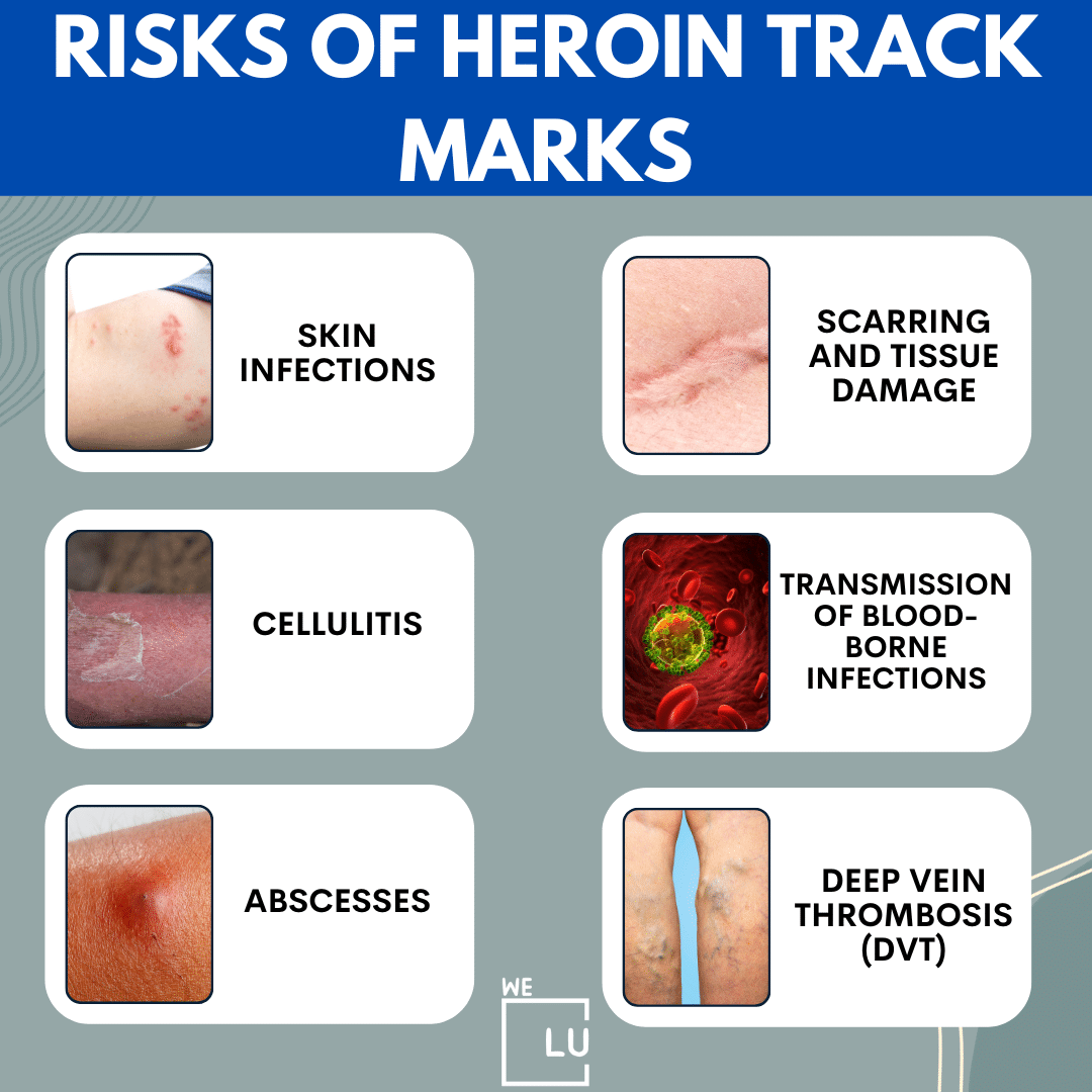 What Are Heroin Track Marks? Recognizing Signs Of Addiction.