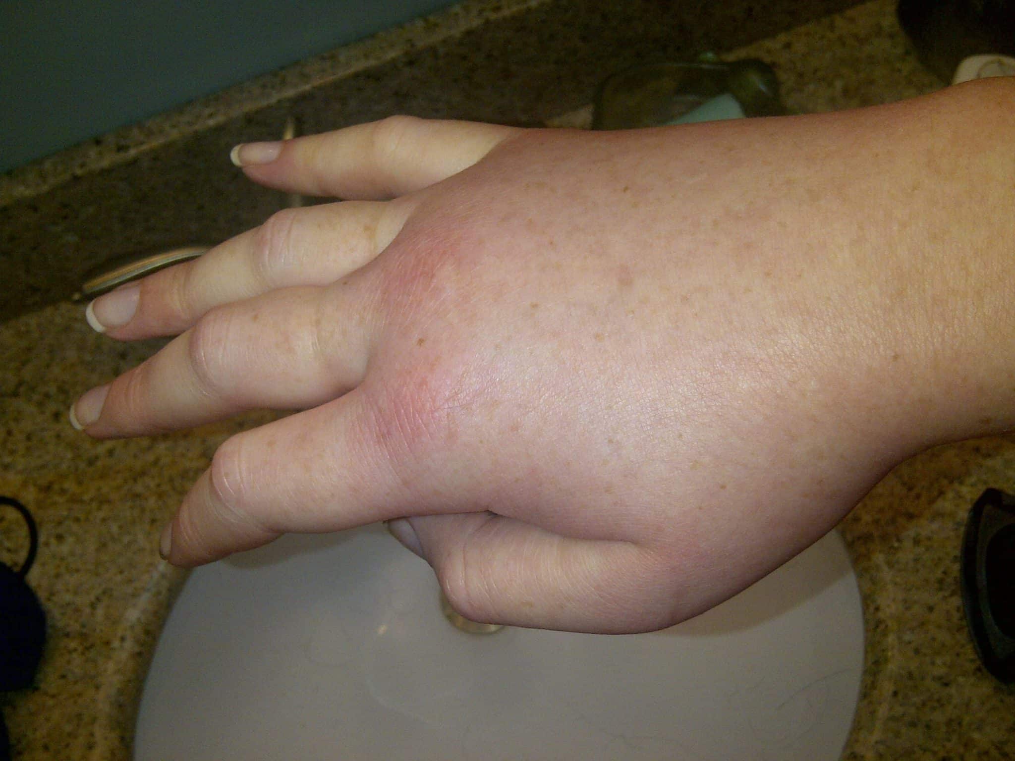 Puffy Hand Syndrome, IV Drug Use, Chronic Vein Disease, A Case Report ...